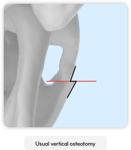 vertical osteotomy